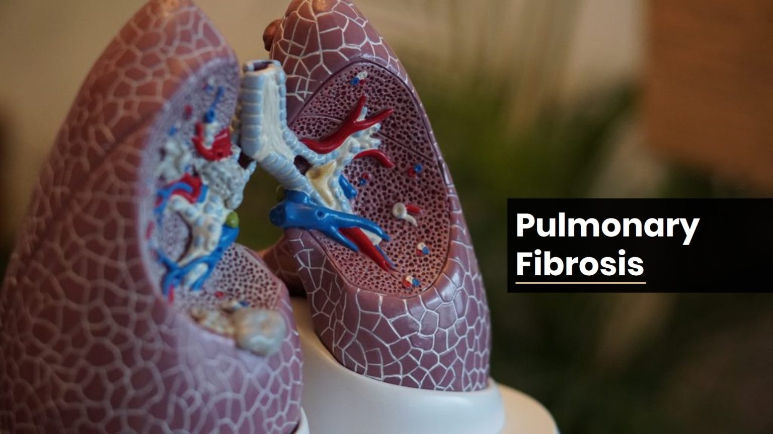 Pulmonary Fibrosis Treatment Ahmedabad